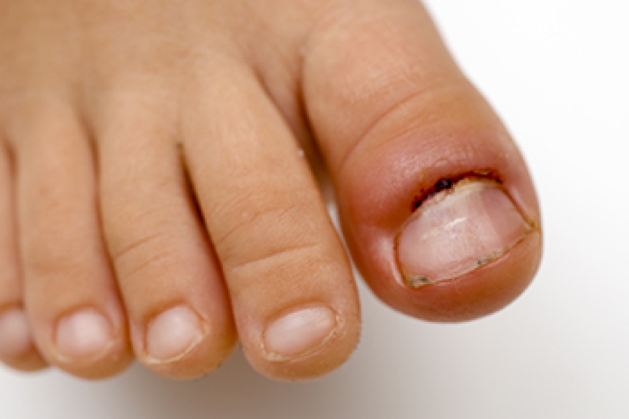 Symptoms and Causes of an Infected Toe